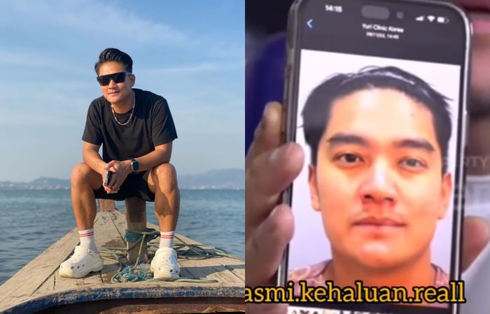 Boy William Operasi Plastik? Wajahnya Mendadak Berubah sampai Bikin ...