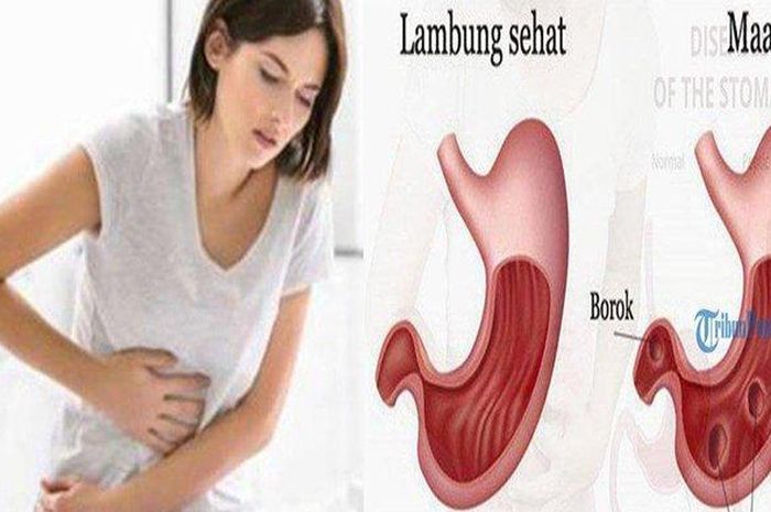 Serupa tapi Tak Sama, Inilah Perbedaan Maag dan Gerd yang Tak Banyak Orang Tahu Serta Cara ...