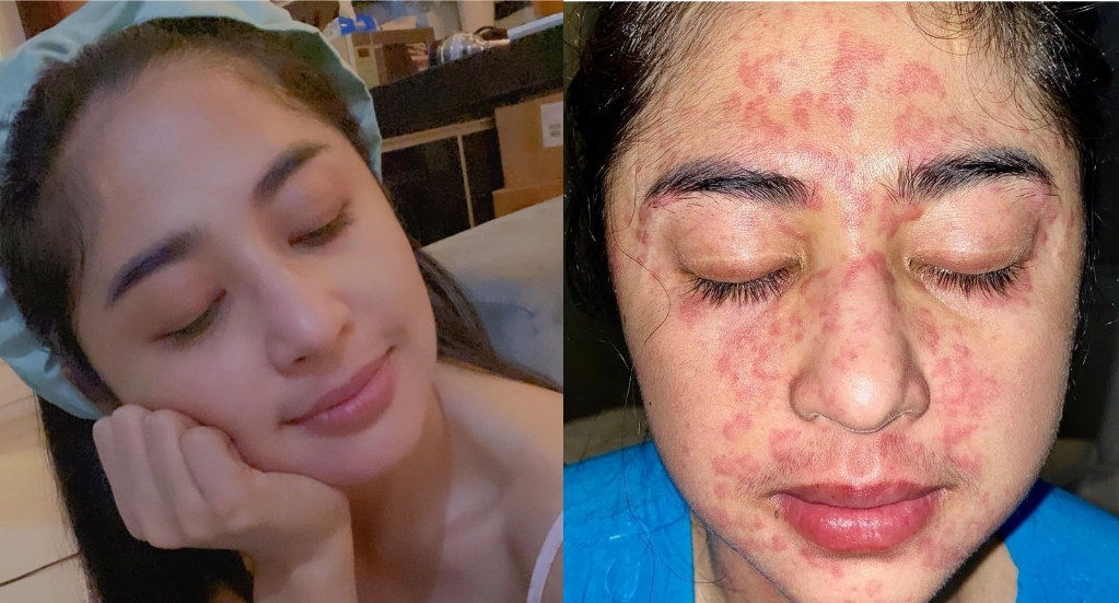 Dewi Perssik Terinfeksi Virus Corona dengan Bercak-bercak Merah ...