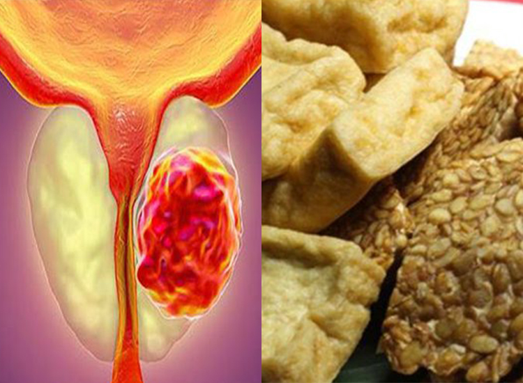 Catat! Makanan untuk Obat Kanker Prostat Ternyata Sering Tersedia di ...