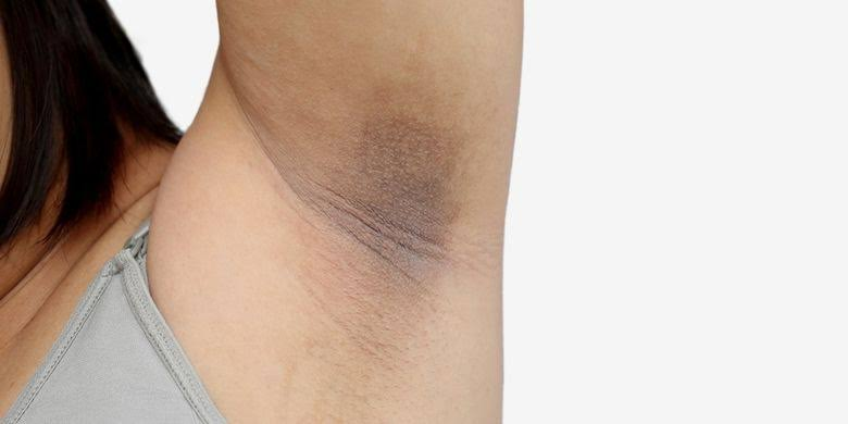 Daki Hitam di Ketiak Hilang dengan Mudah, Ini Caranya Wajib Tahu! | Stylo