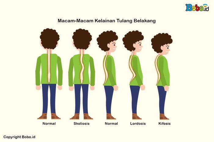 Penjelasan Skoliosis, Lordosis, dan Kifosis yang Merupakan Kelainan ... Penjelasan Skoliosis, Lordosis, dan Kifosis yang Merupakan Kelainan ...