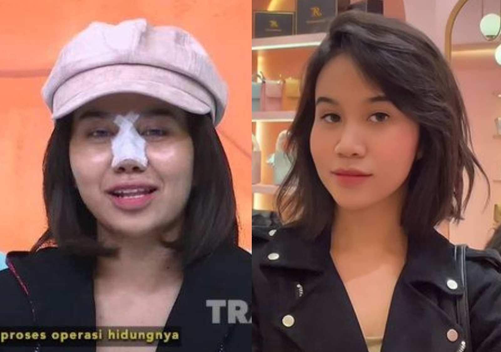 Mayang Gelontorkan Rp50 Juta untuk Opersi Hidung, Adik Vanessa Angel ...