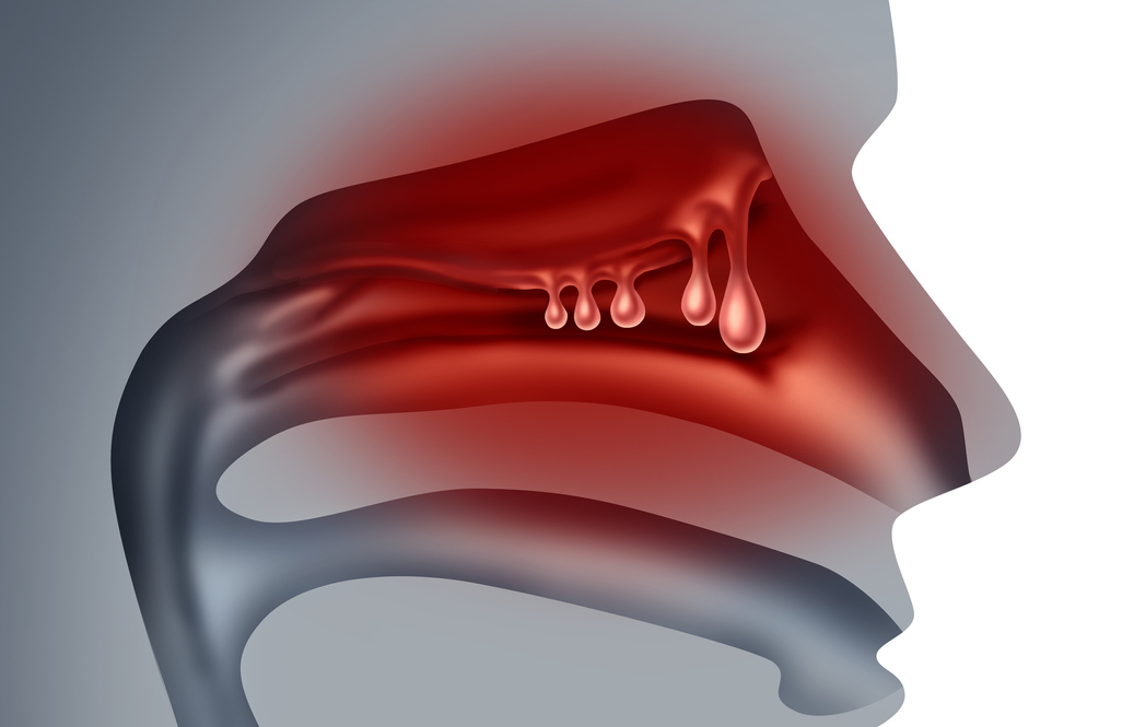 Tips Hidup: 7 Penyebab Polip Hidung yang Wajib Diwaspadai, Jangan ...